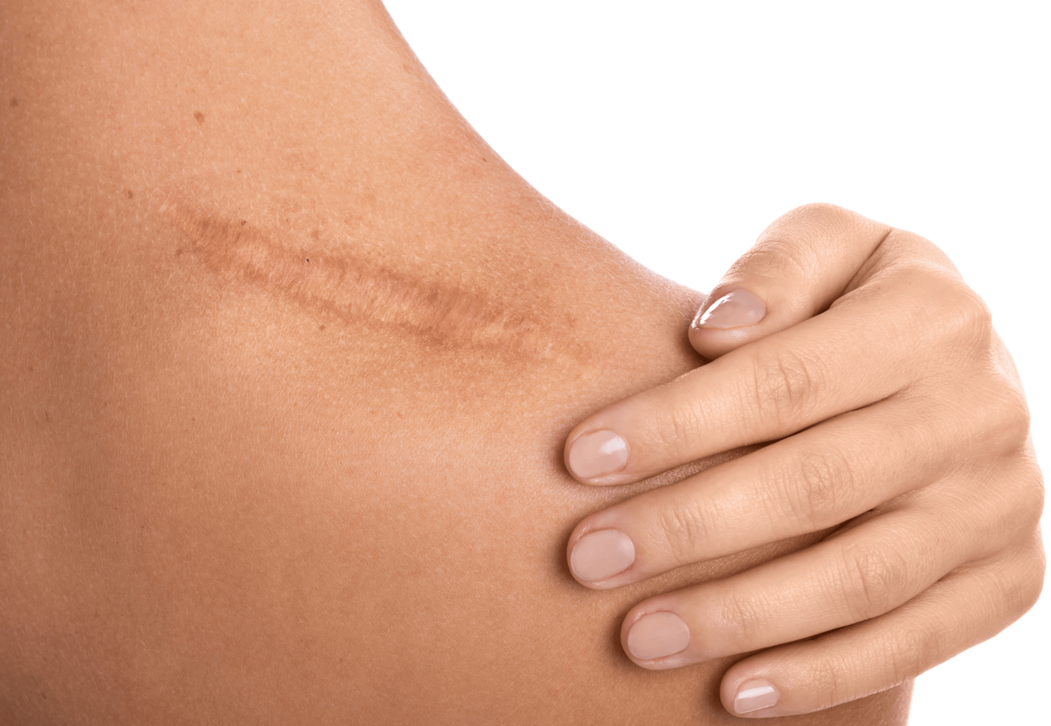 ¿Qué es la Fibrosis Cicatricial? | MOV Rehabilitación